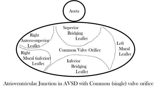 What is a left atrioventricular valve cleft? – TALKING HEARTS