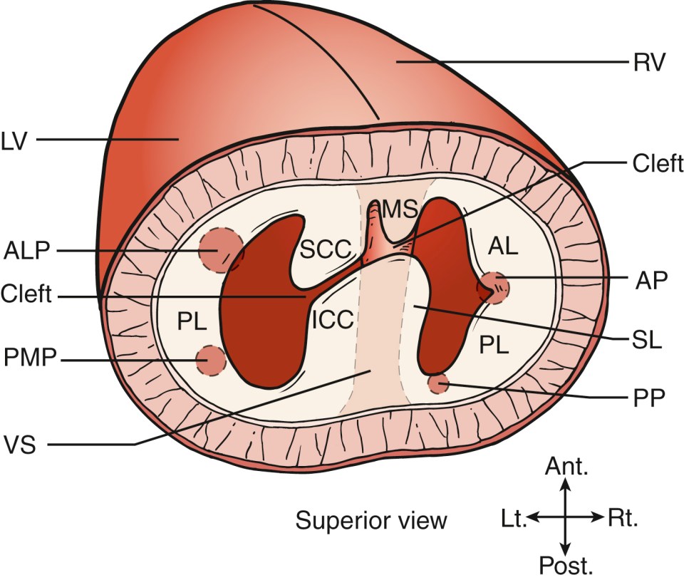 What is a left atrioventricular valve cleft? – TALKING HEARTS